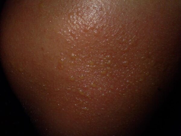 Medication and Sun Sensitivity